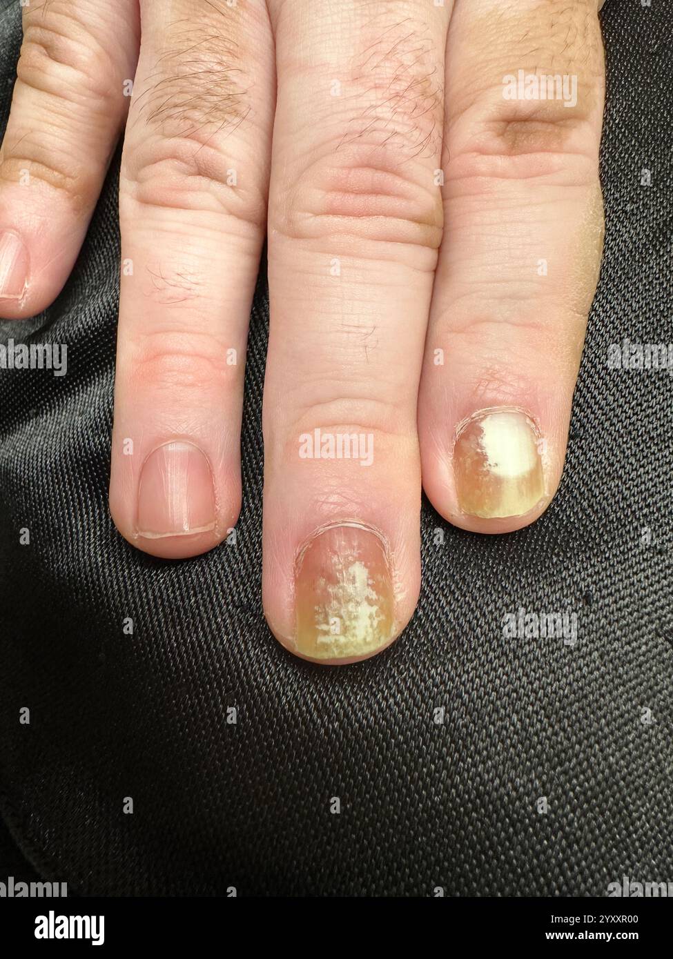 Infection fongique des ongles. Connue sous le nom â onychomycose, ou ...