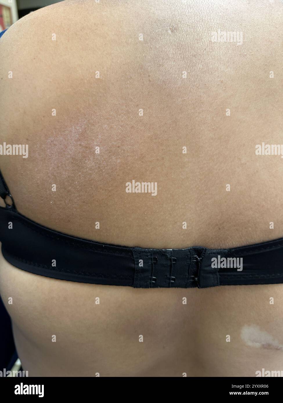 Notalgia paresthetica. C'est un désordre des nerfs dans le haut du dos ...