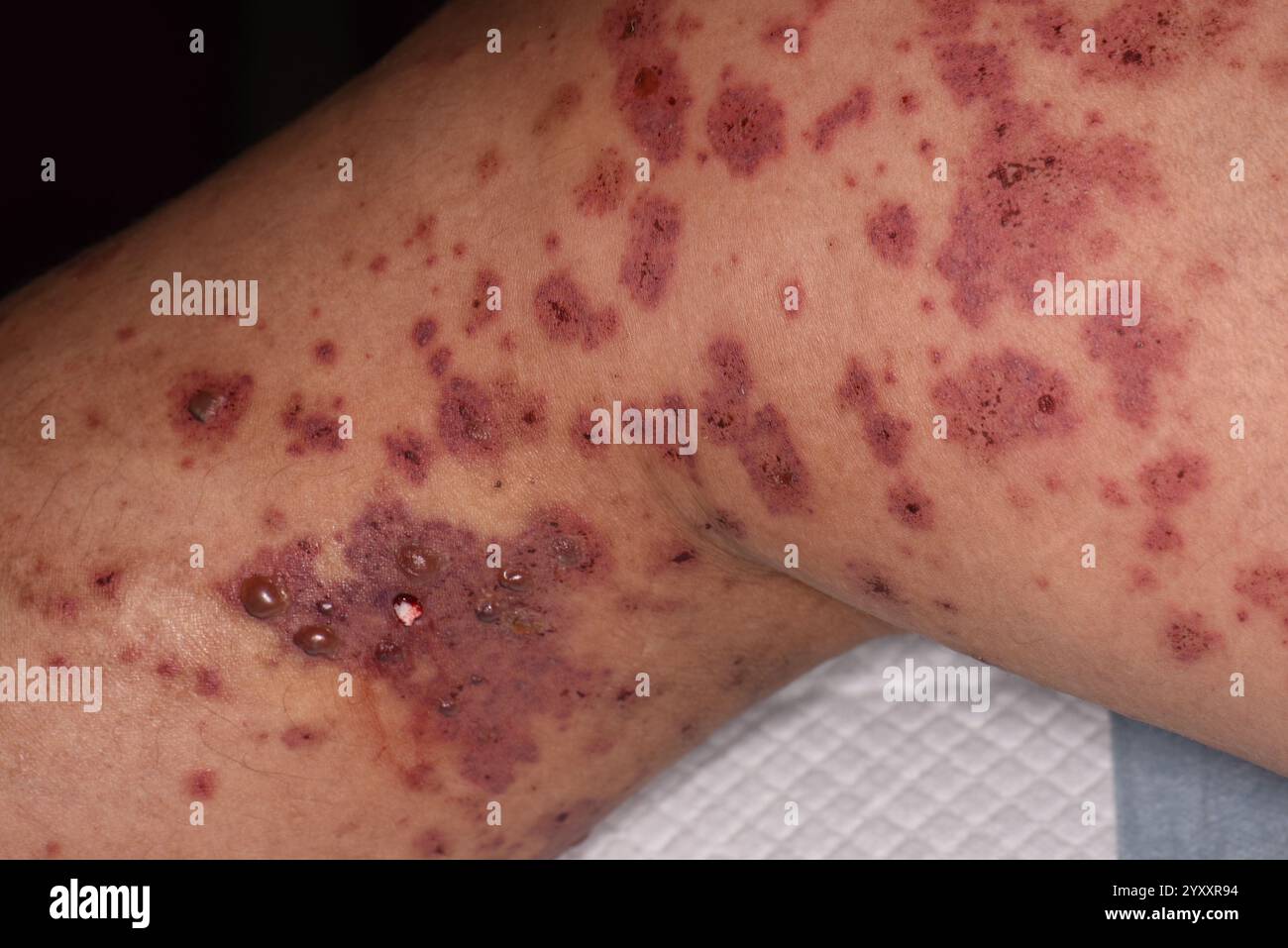 Vascularite à IgA (immunoglobuline A) sur la jambe d'une patiente ...