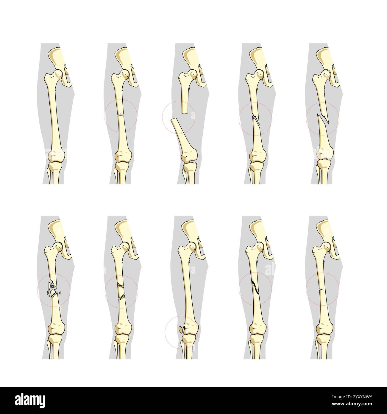Types bone fractures Banque de photographies et d’images à haute ...