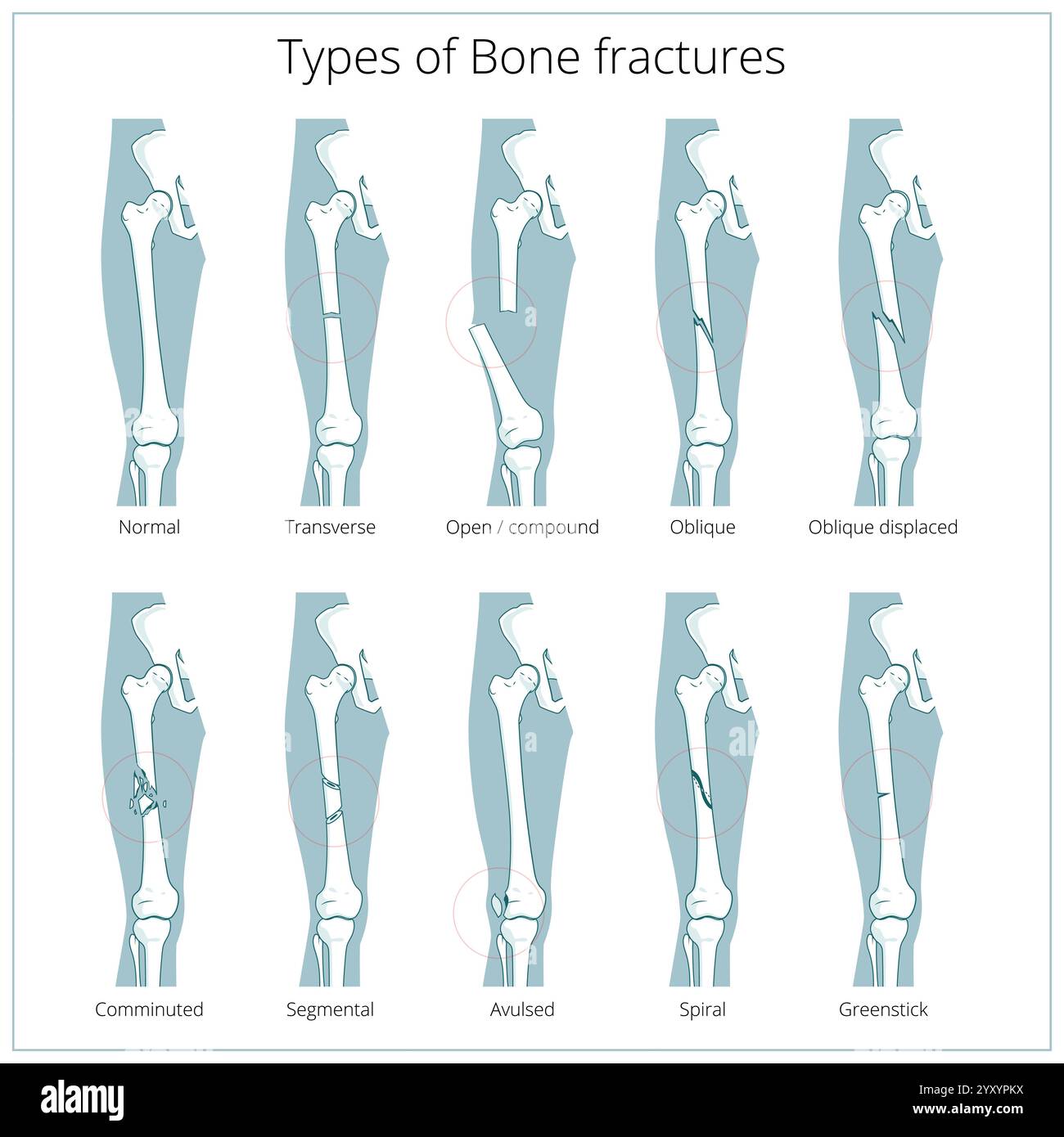 Types bone fractures Banque de photographies et d’images à haute ...