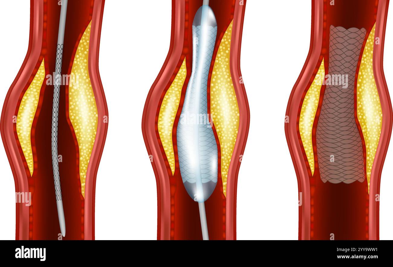 Illustration de la procédure d'angioplastie. Angioplastie par ballonnet ...