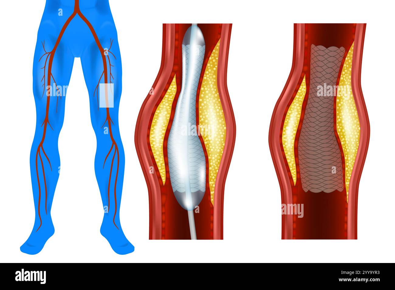 Procédure d'angioplastie des membres inférieurs. Schéma d'angioplastie ...