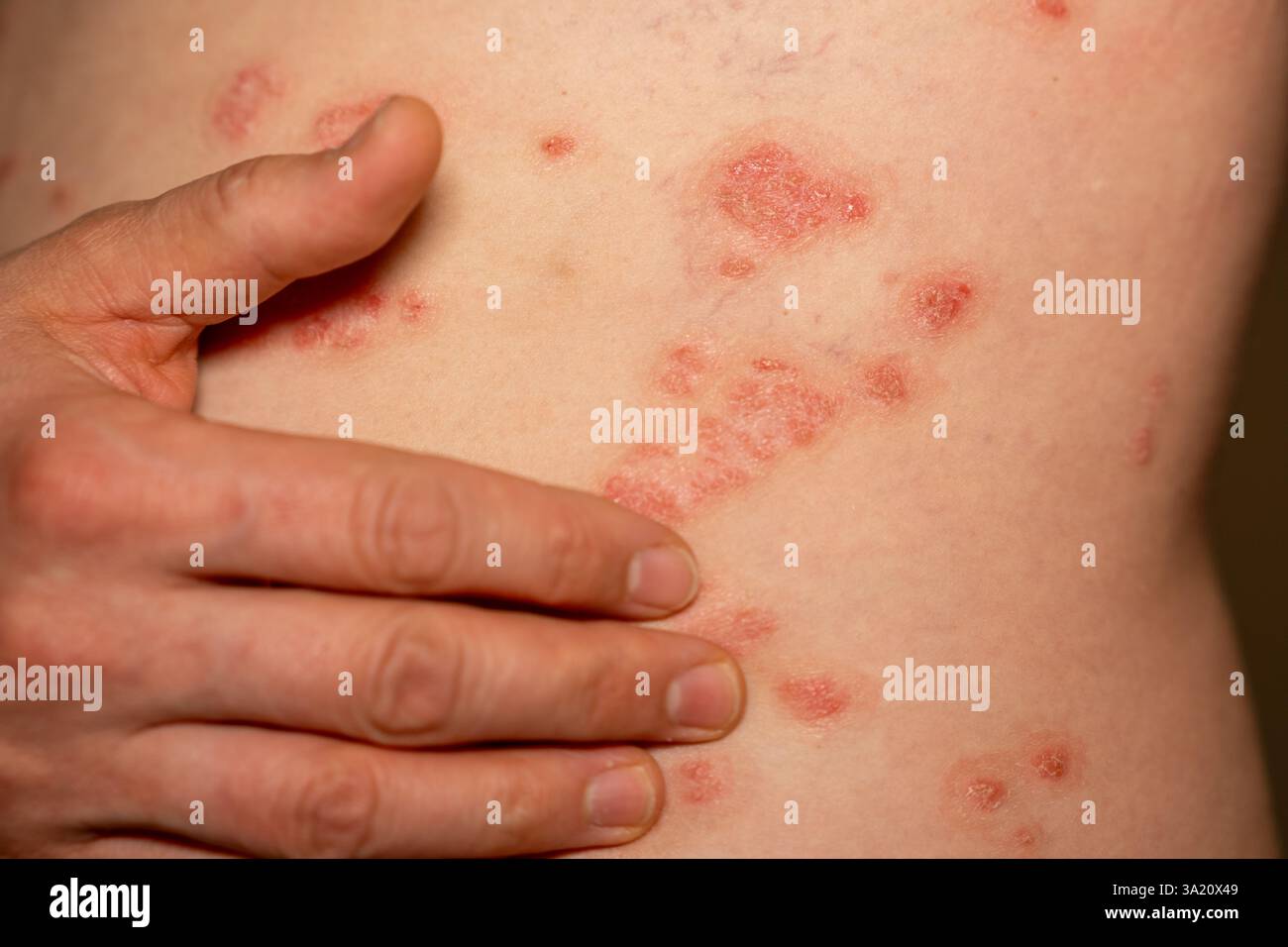 Plaques rouges et squameuses de psoriasis sur la peau soulignant l ...