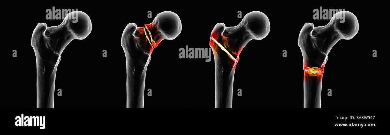 Types bone fractures Banque de photographies et d’images à haute ...