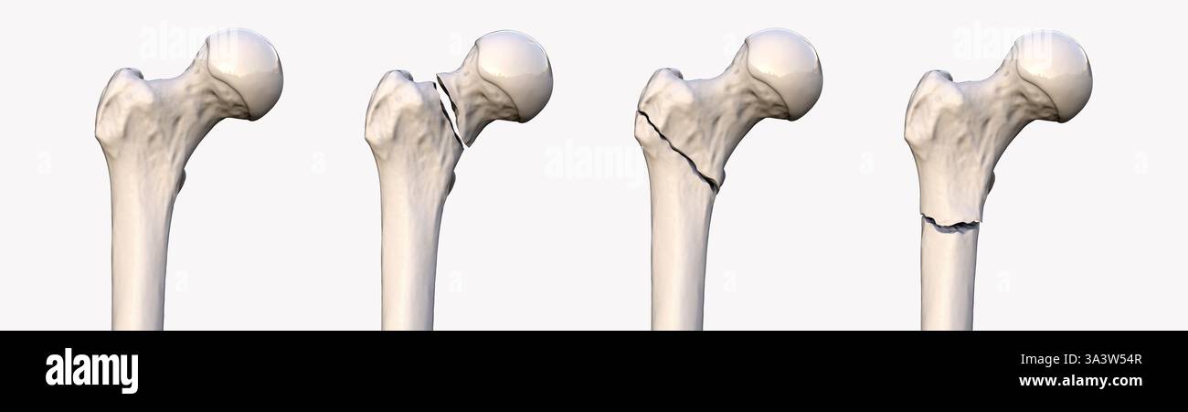 Illustration des types de fractures du fémur : fémur normal, fracture ...