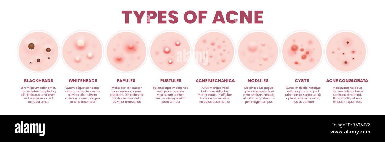 Infographie de l'inflammation des pores de type acné. Points noirs ...