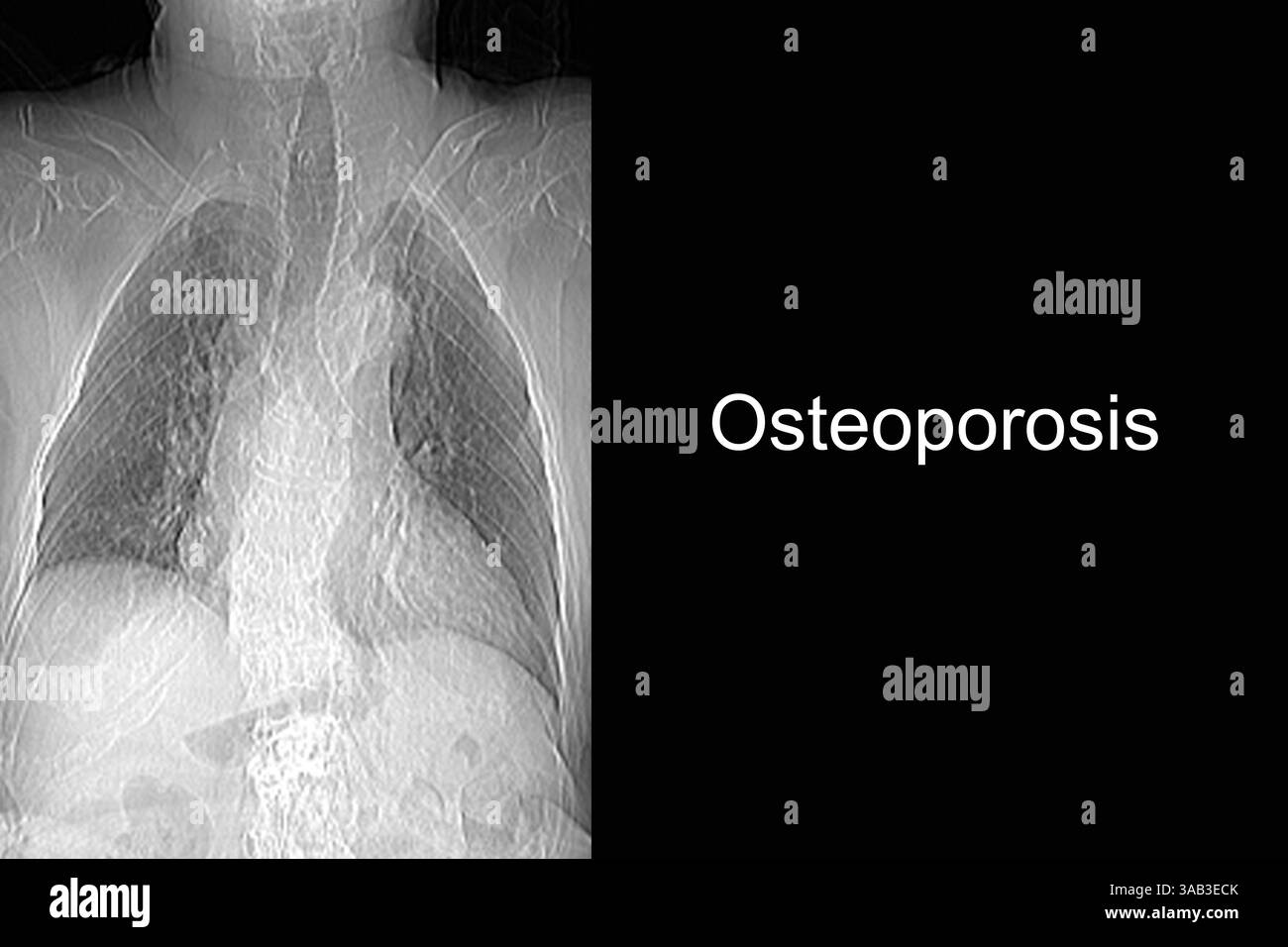 Compression fractures Banque de photographies et d’images à haute ...