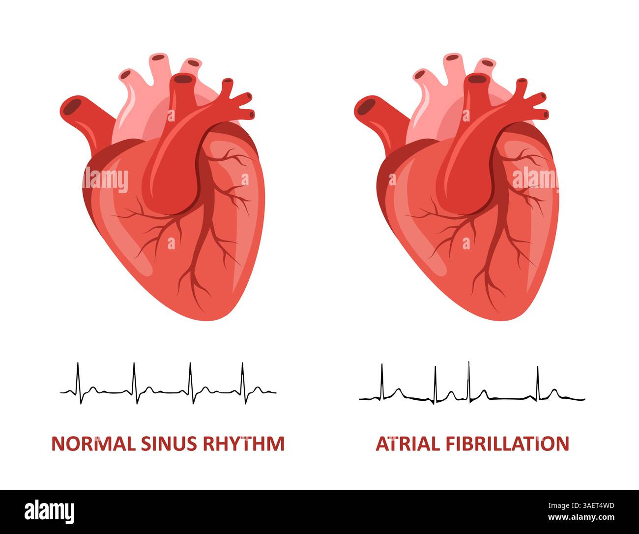 Maladies cardiaques. Rythme sinusal normal et fibrillation auriculaire ...