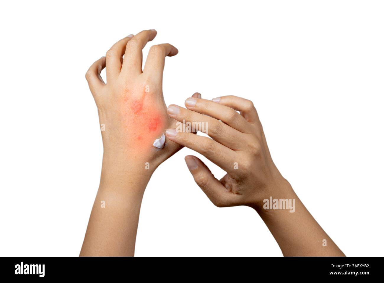 Taches sur la peau Banque d'images détourées - Alamy