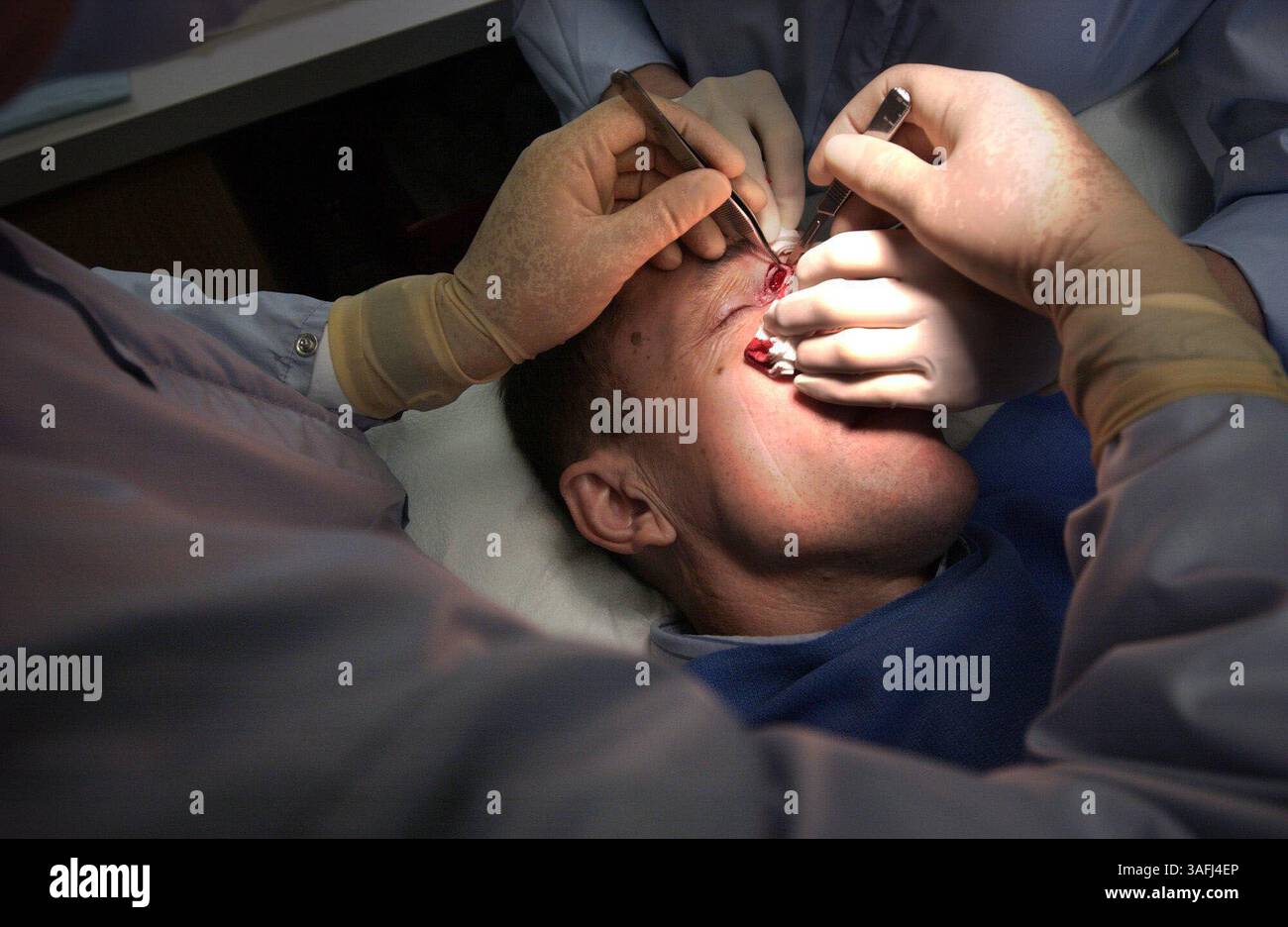 Dr Martin Braun enlève un carcinome basocellulaire de la zone entre le ...