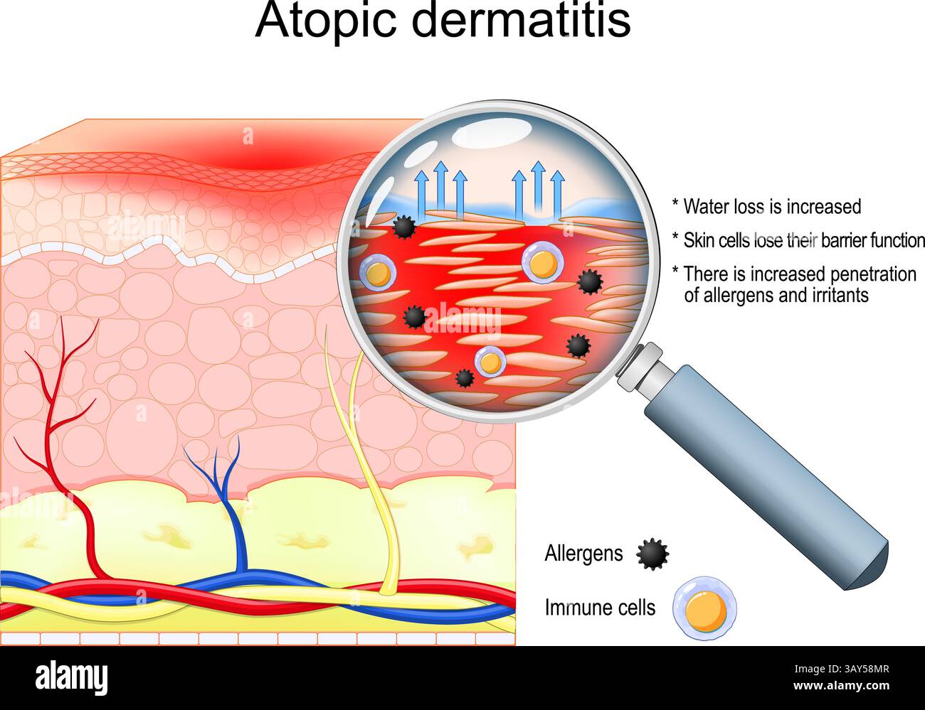 Infantile eczema atopic dermatitis Banque d'images vectorielles - Alamy