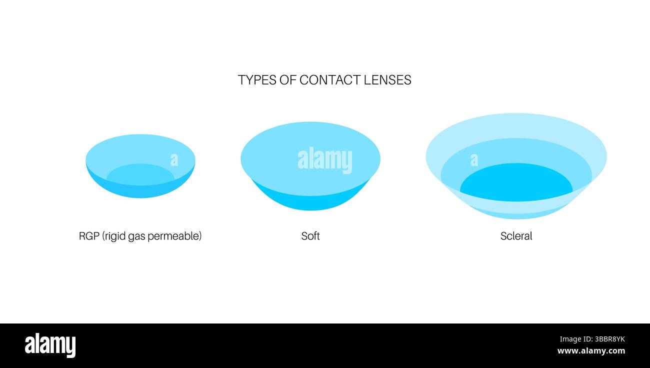 Illustration des types de lentilles de contact, y compris rigides perméables aux gaz (RGP ...