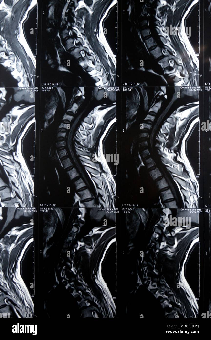 L'IRM de la colonne cervicale révèle des changements ...