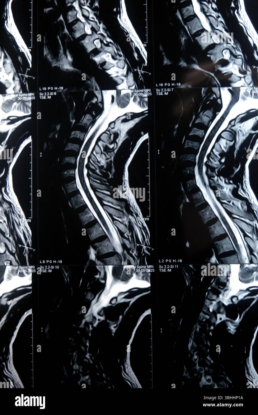 L'IRM de la colonne cervicale révèle des changements ...