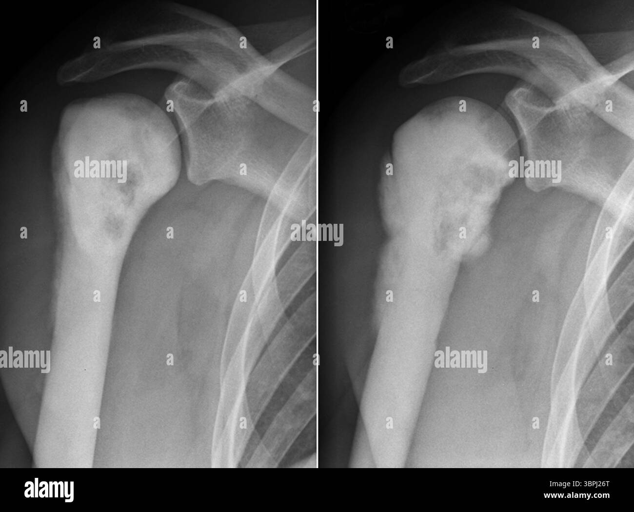 La radiographie de l'articulation de l'épaule d'une patiente de 21 ans ...