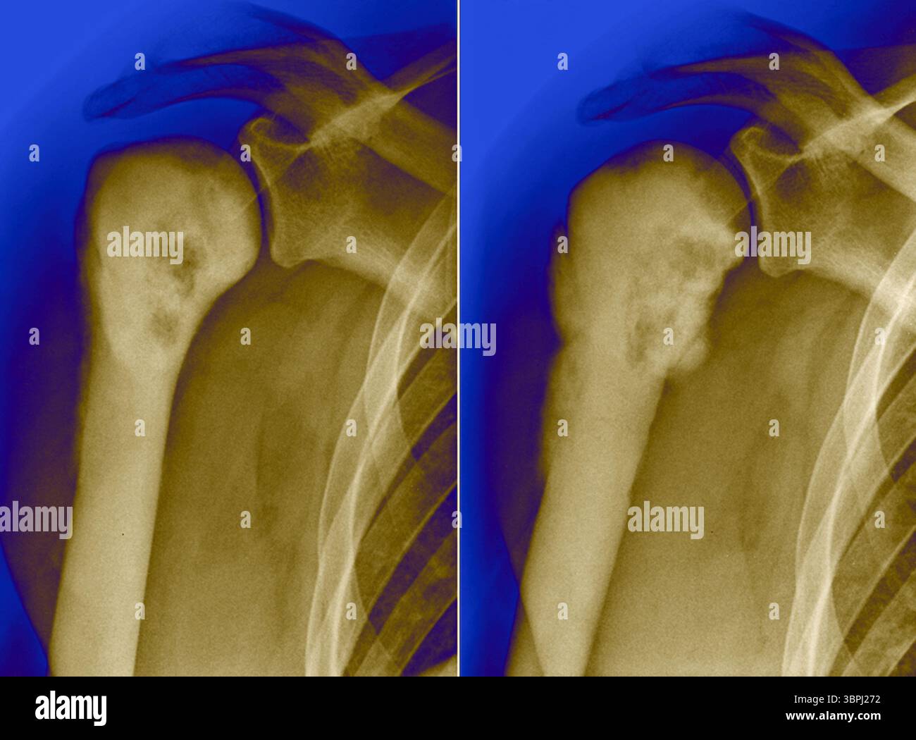 La radiographie de l'articulation de l'épaule d'une patiente de 21 ans ...