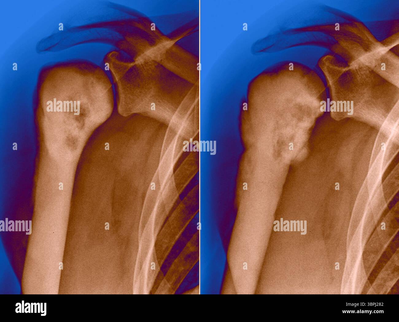 La radiographie de l'articulation de l'épaule d'une patiente de 21 ans ...