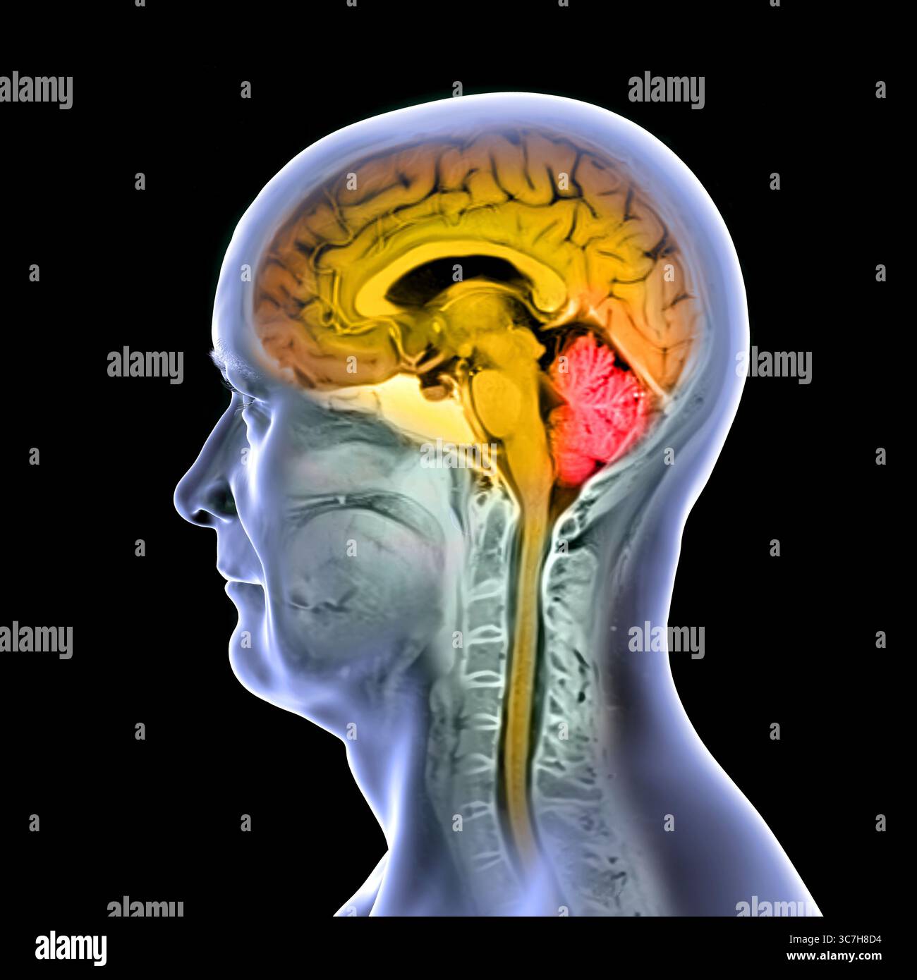 Illustration d’une imagerie par résonance magnétique (IRM) colorée du ...