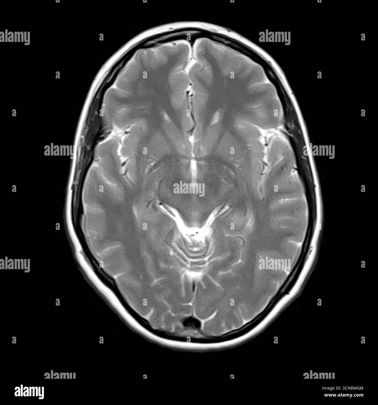 Anatomie du cerveau moyen Banque d'images noir et blanc - Alamy