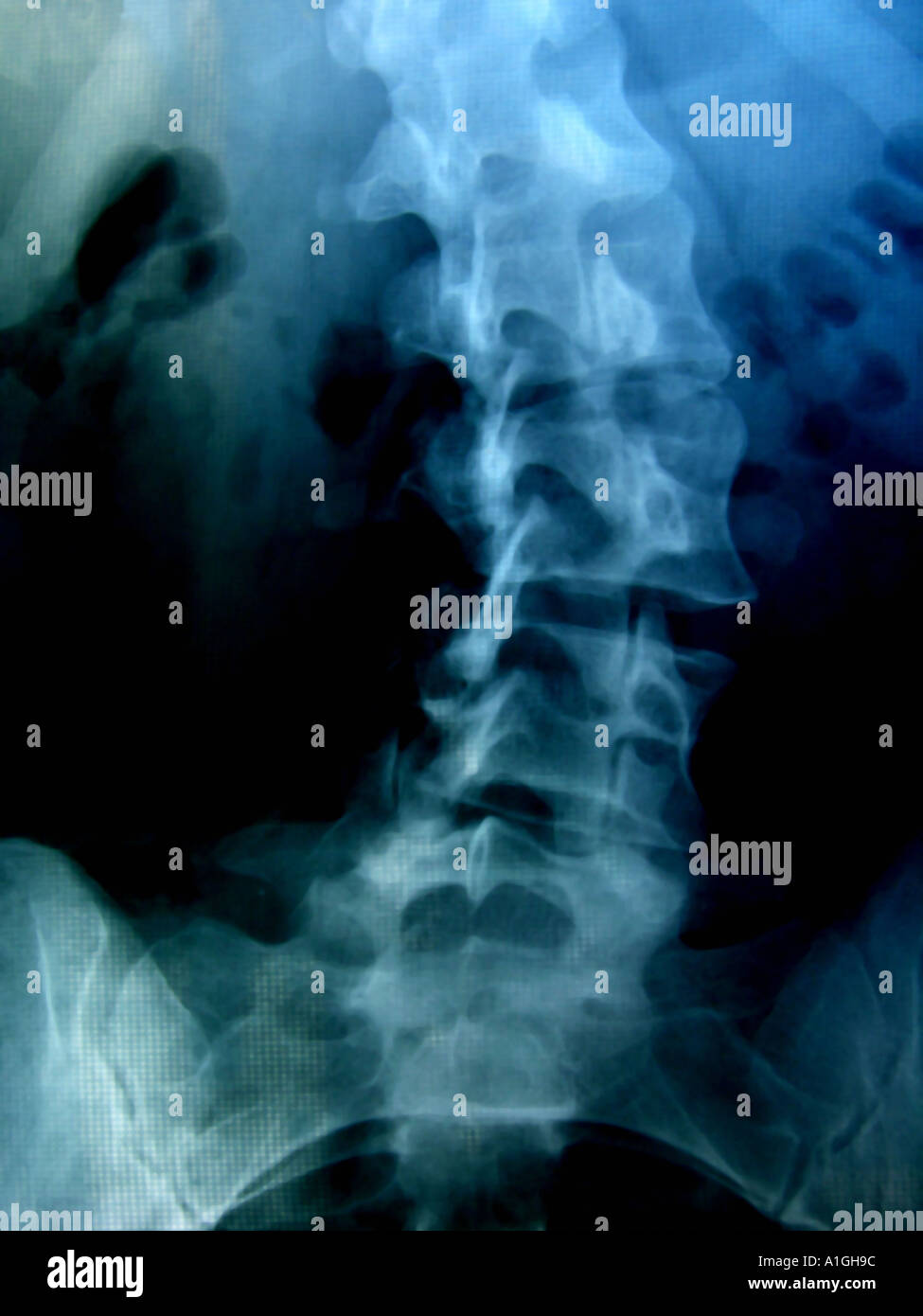 Radiographie de la scoliose Banque de photographies et d’images à haute ...