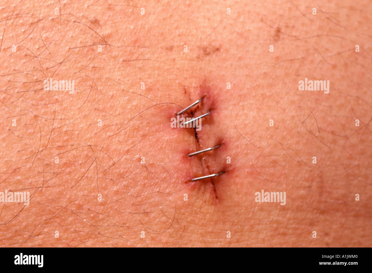 Points de suture après la chirurgie Banque de photographies et d’images ...