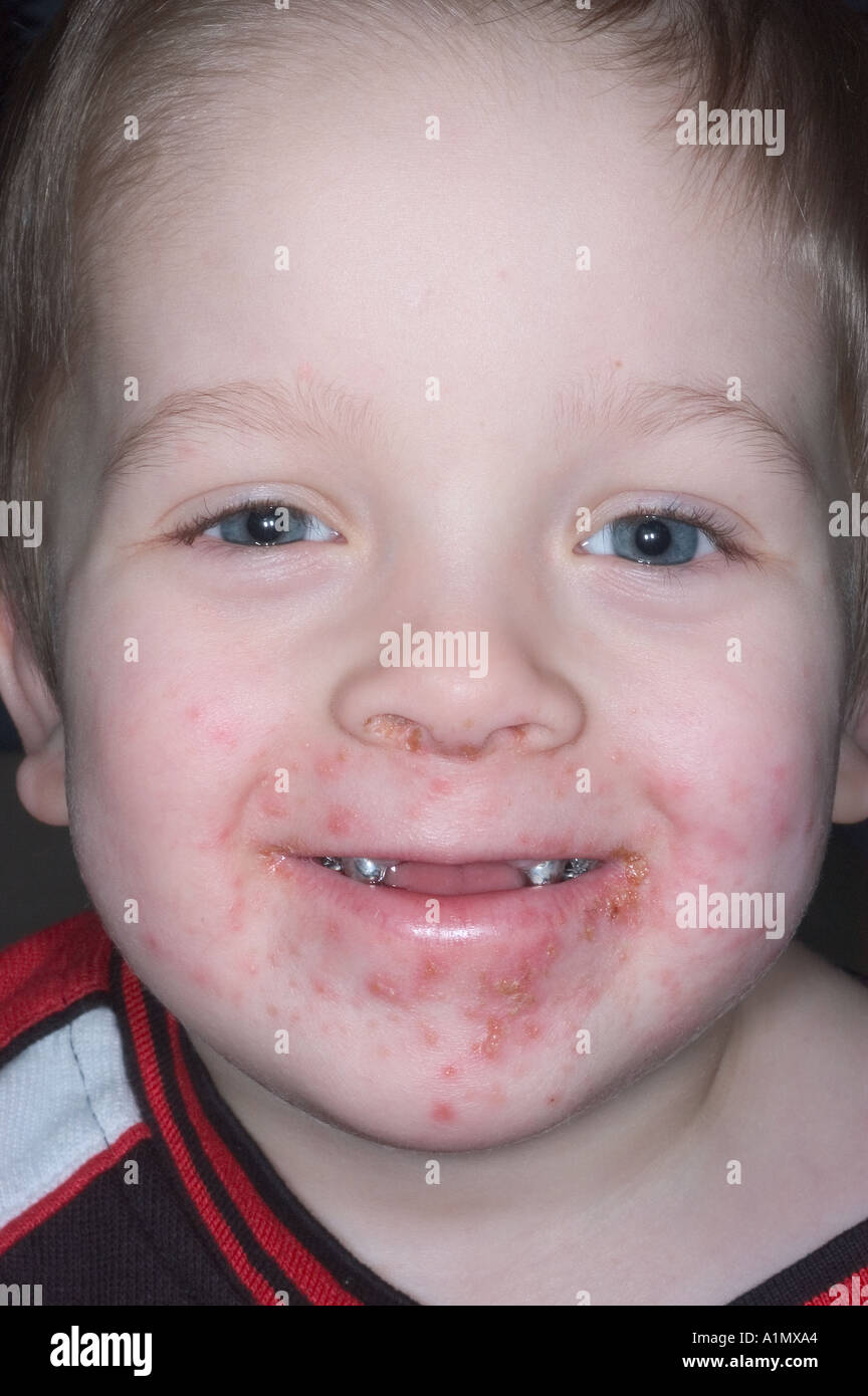 Child impetigo rash Banque de photographies et d’images à haute ...