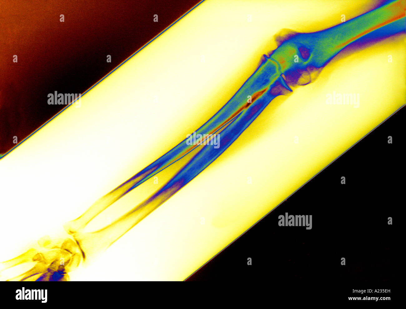 Fracture de l'avant bras Banque de photographies et d’images à haute ...