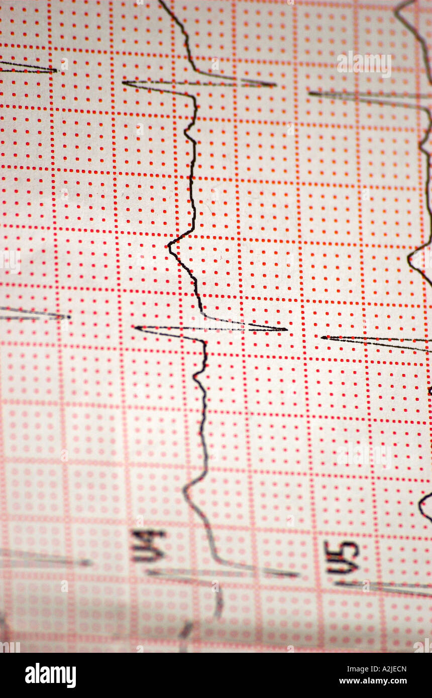 électrocardiogramme normal Banque de photographies et d’images à haute ...