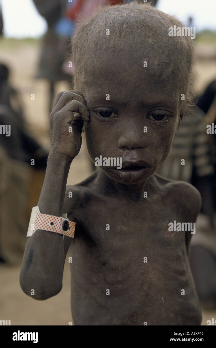 Malnourished sudan Banque de photographies et d’images à haute ...