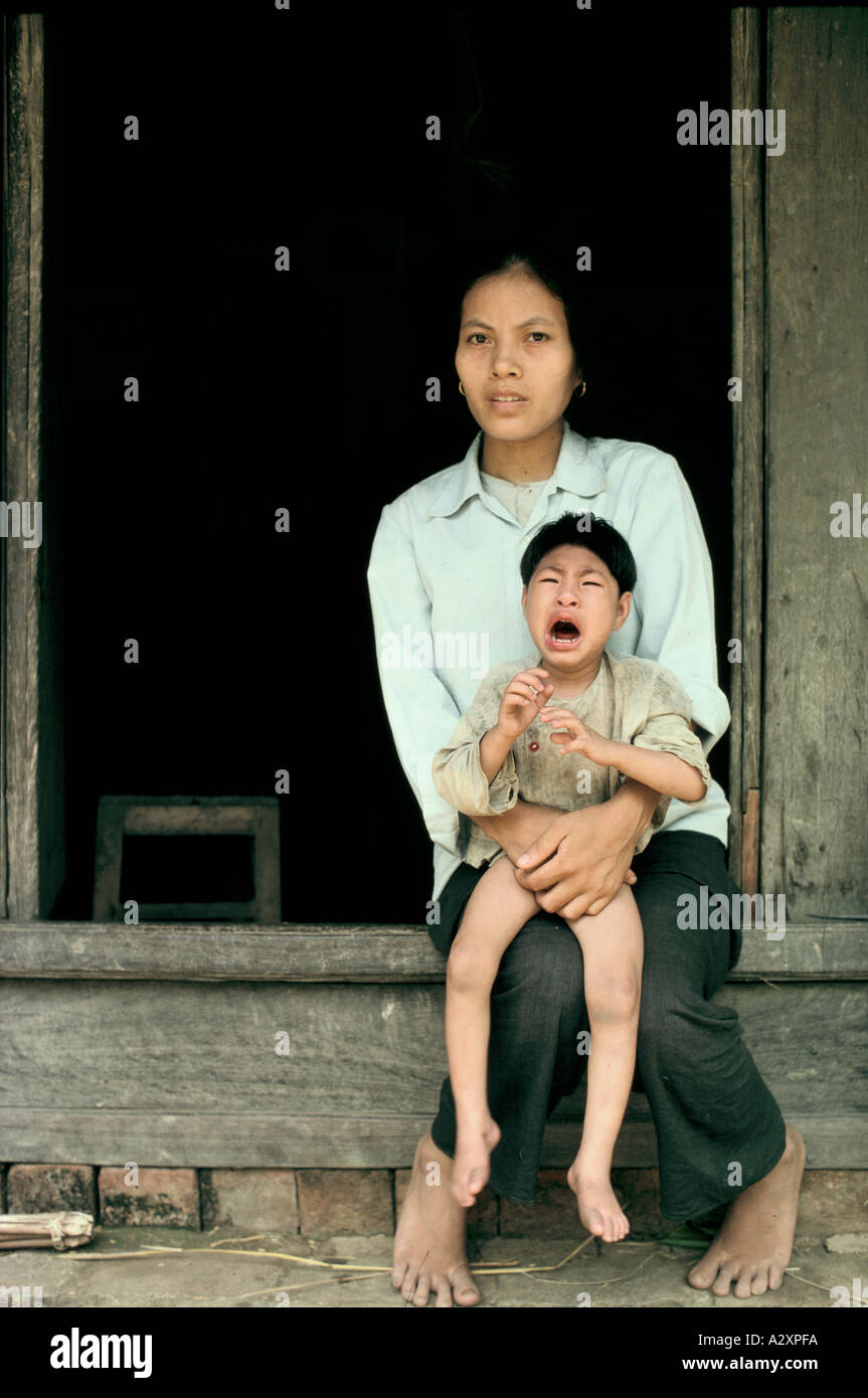 Quyen, 4, a microcéphalie - petit cerveau cerveau. Son père a été ...