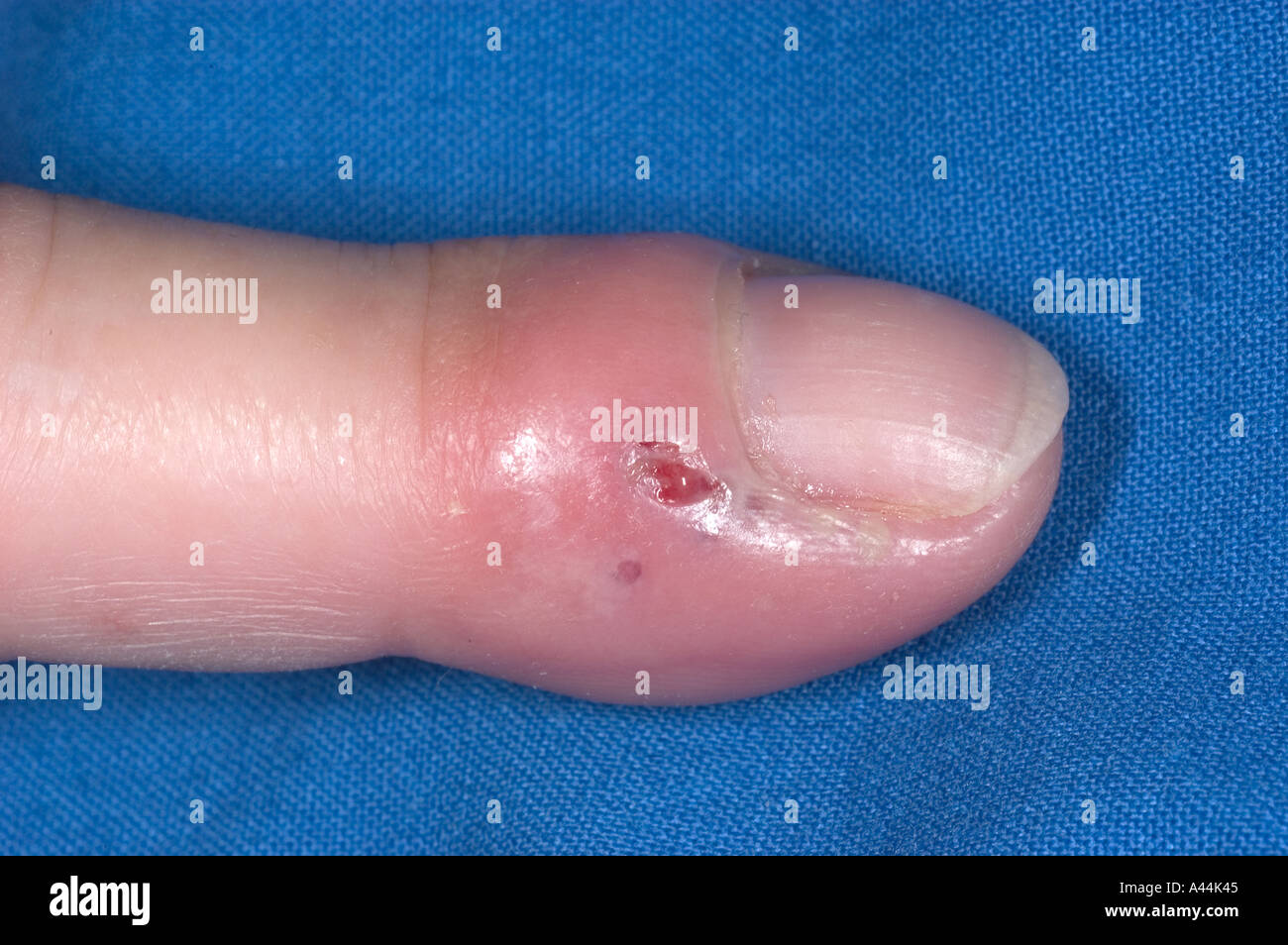 Panaris doigt Banque de photographies et d’images à haute résolution ...