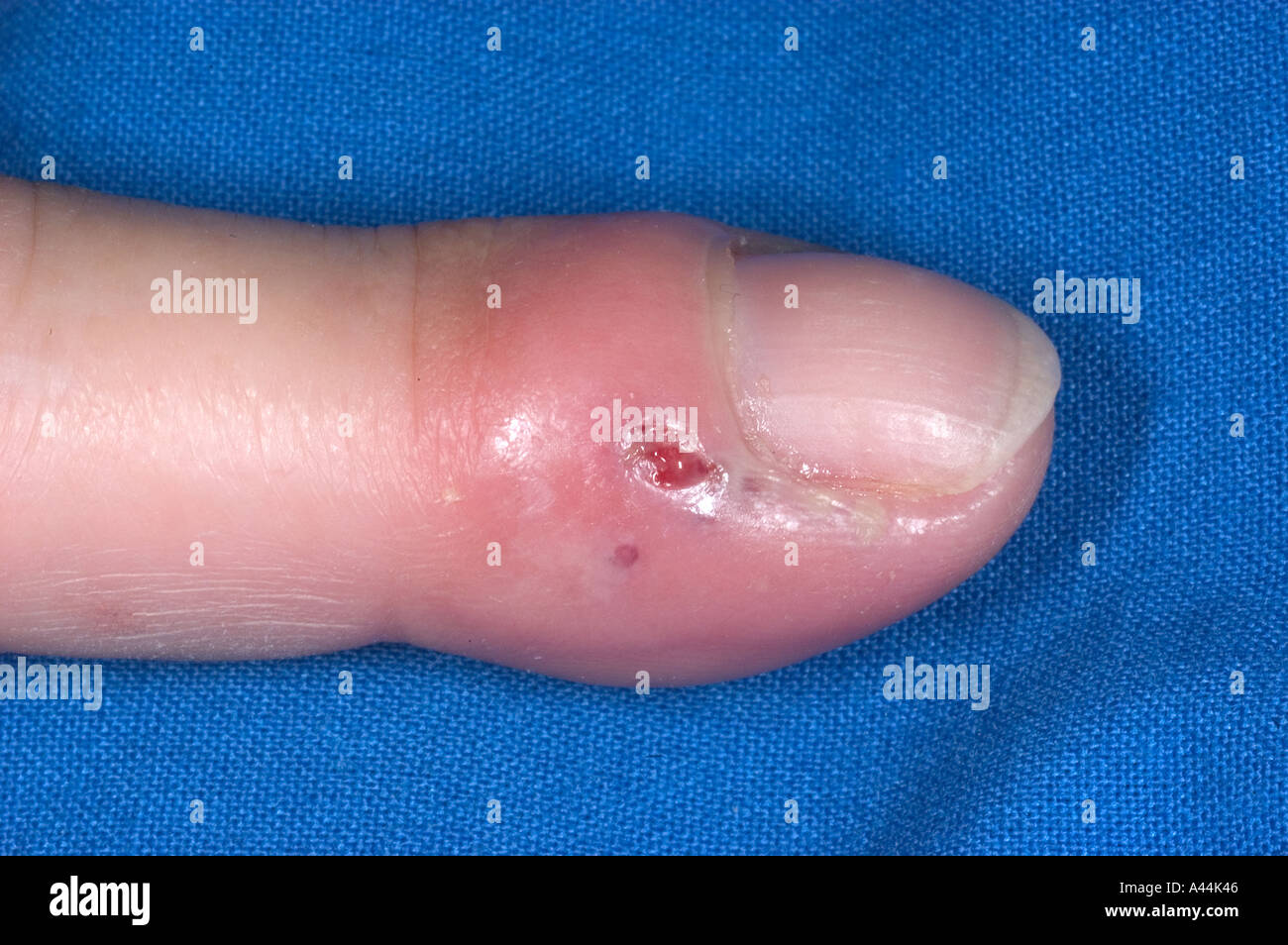 Panaris doigt Banque de photographies et d’images à haute résolution ...