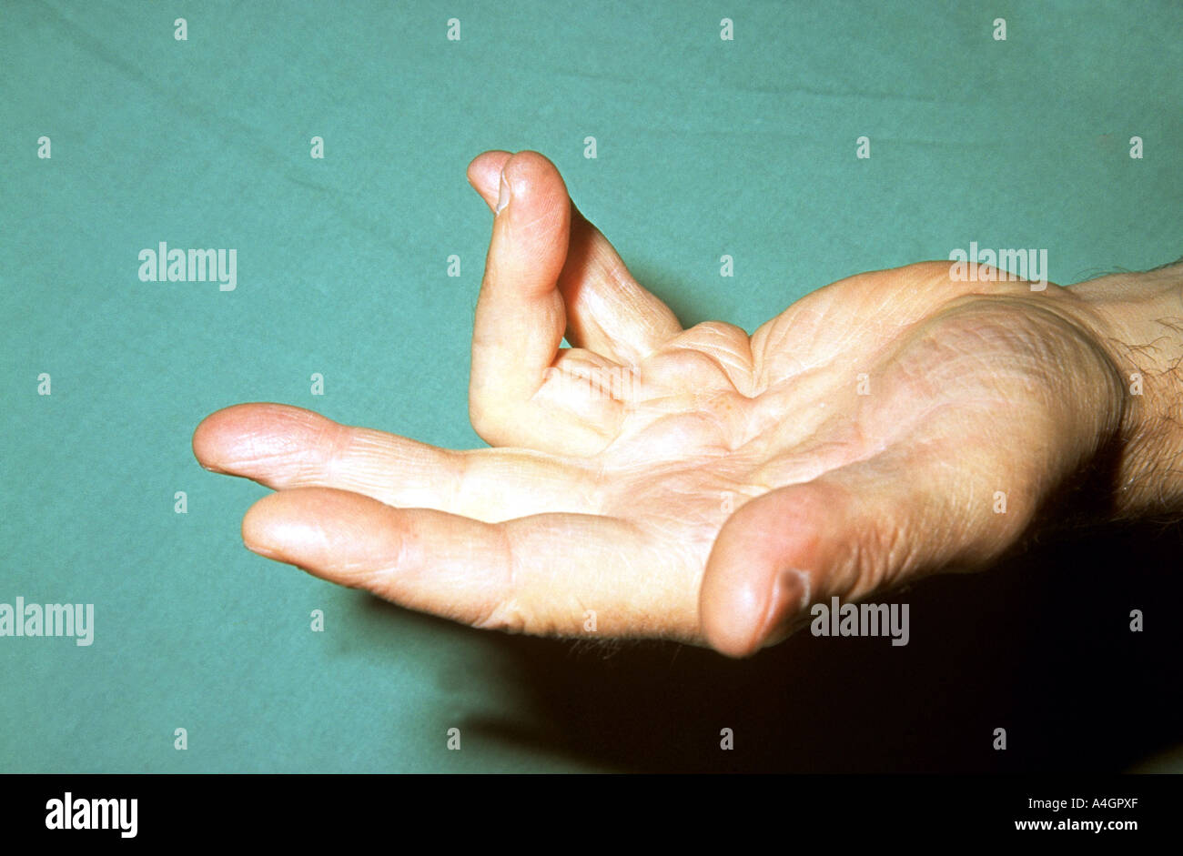 Palmar fibromatosis Banque de photographies et d’images à haute ...