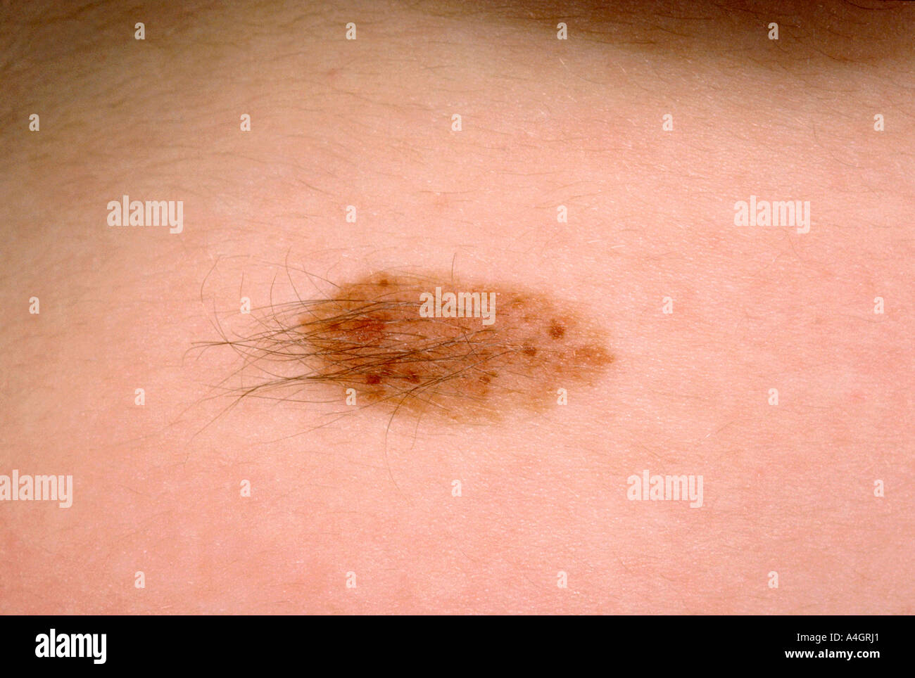 Naevus poilu Banque de photographies et d’images à haute résolution - Alamy