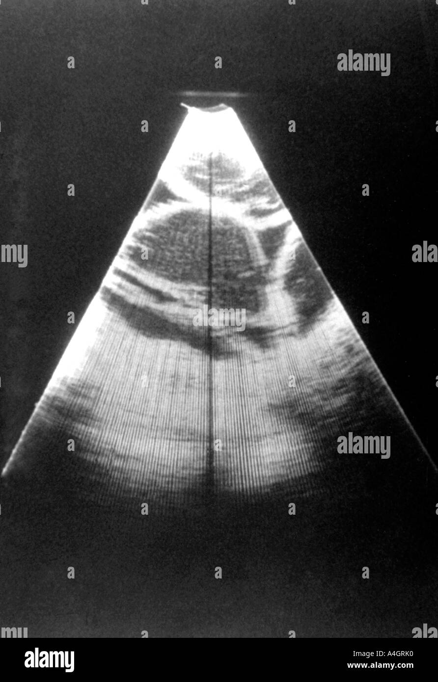 Kyste hydatique du foie Banque d'images noir et blanc - Alamy