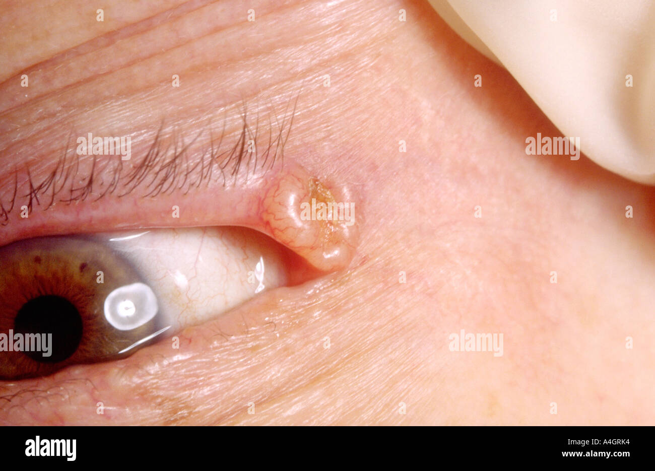 Basal cell carcinoma bcc Banque de photographies et d’images à haute ...