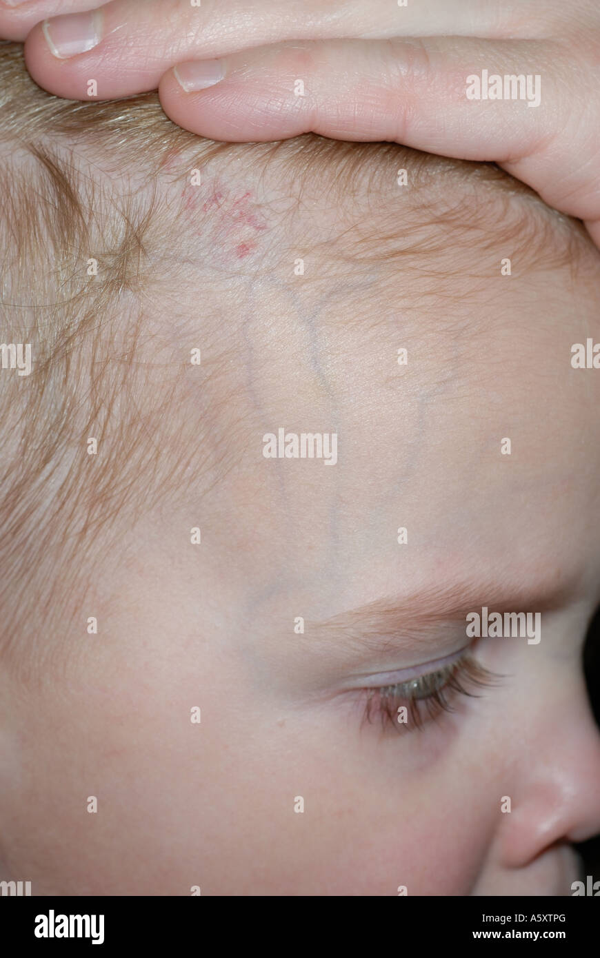 Infant with hemangioma Banque de photographies et d’images à haute ...