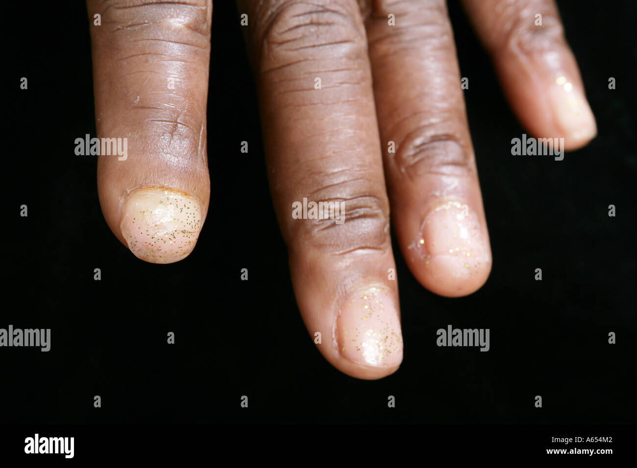 Syndrome de raynaud Banque de photographies et d’images à haute ...