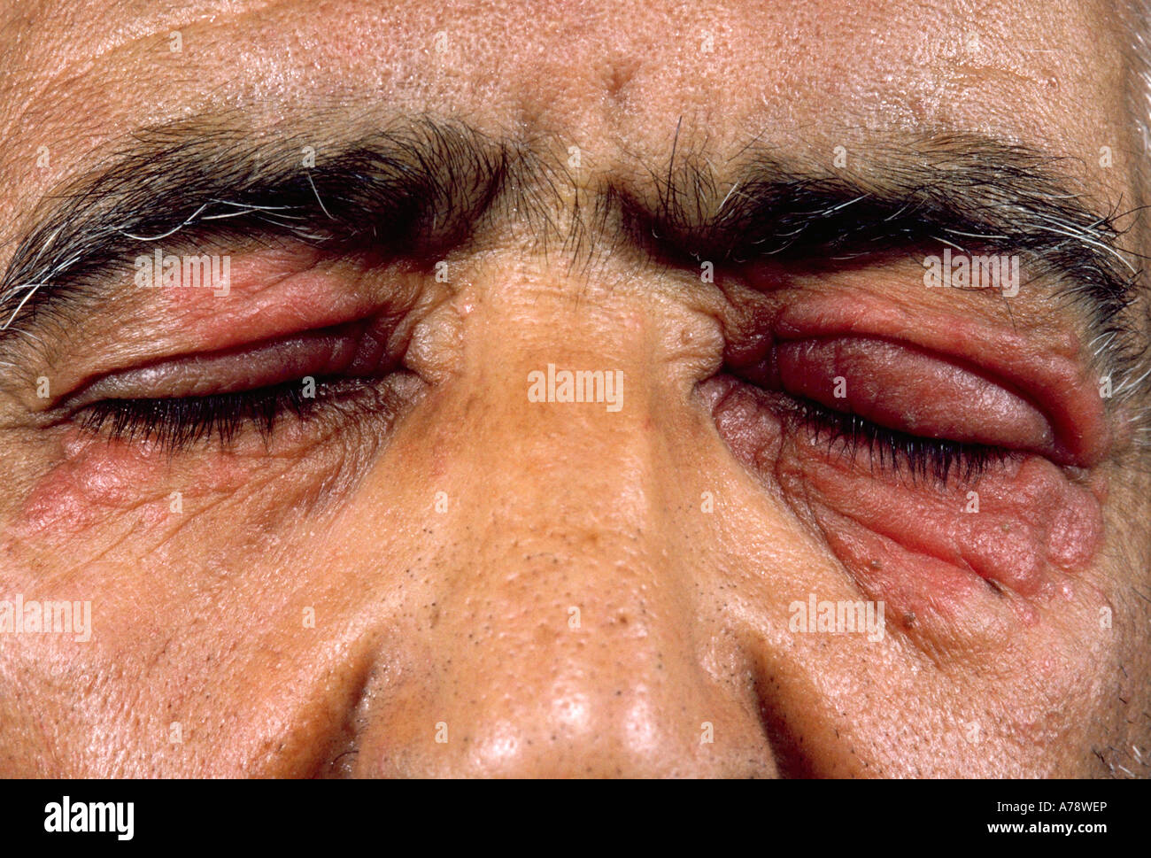 Allergic contact eczema dermatitis rash Banque de photographies et d ...