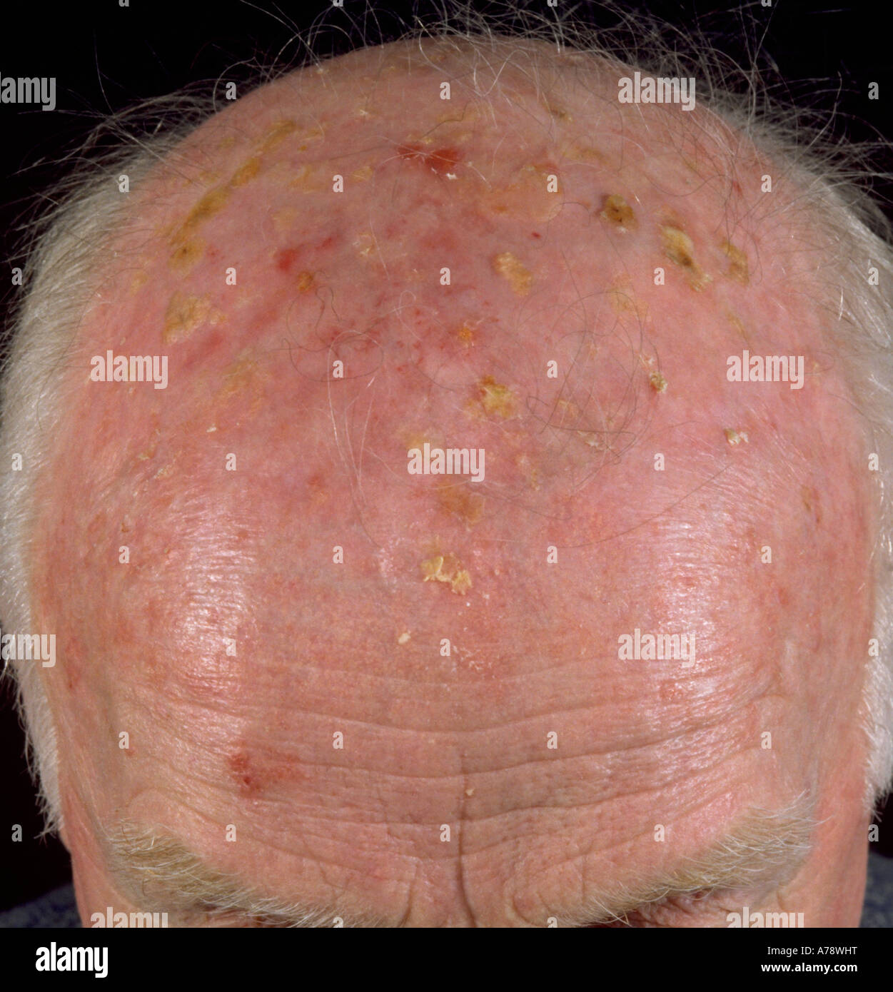 La kératose actinique Photo Stock - Alamy