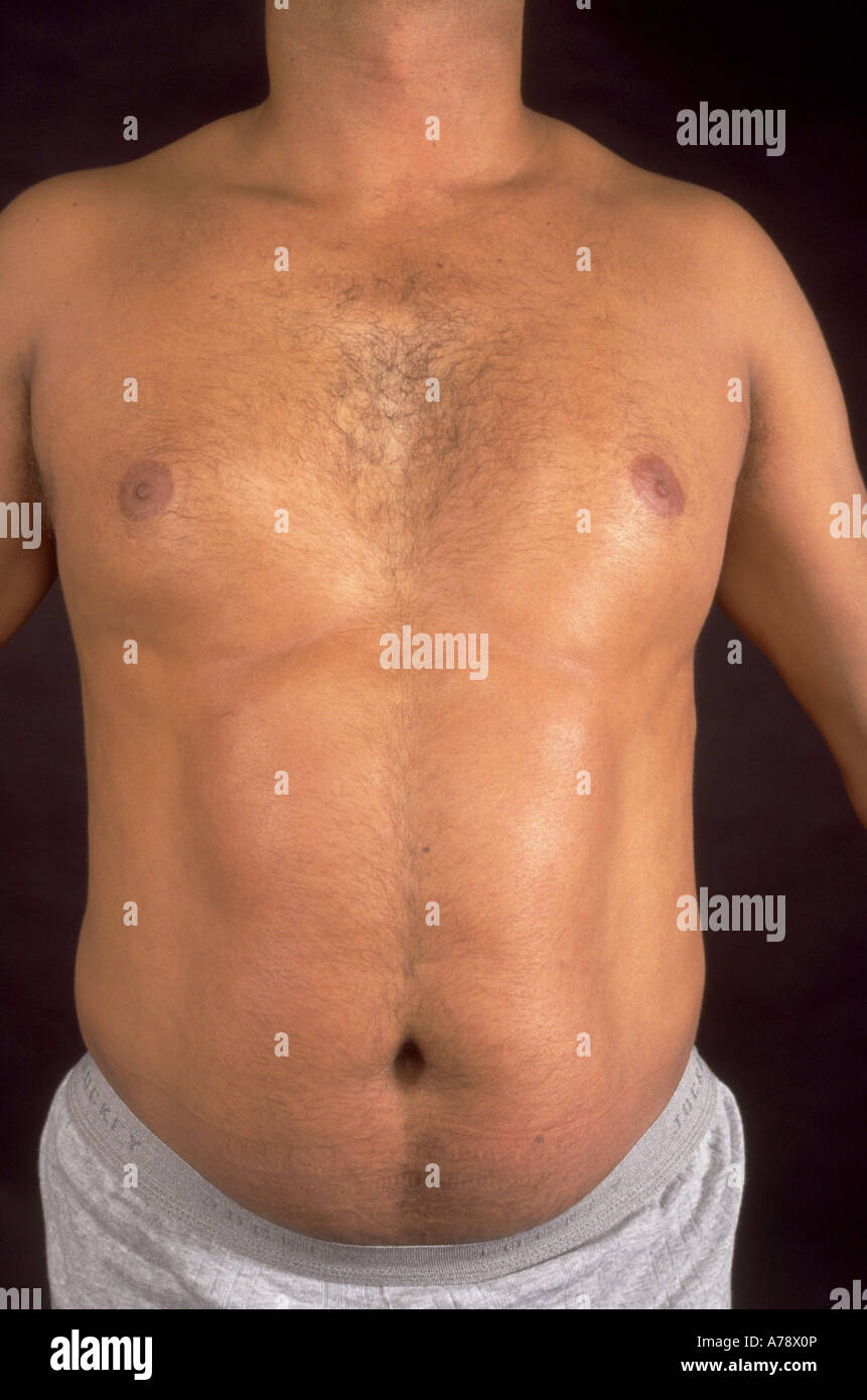 Une photographie d'un homme avec le VIH syndrome de lipodystrophie ...