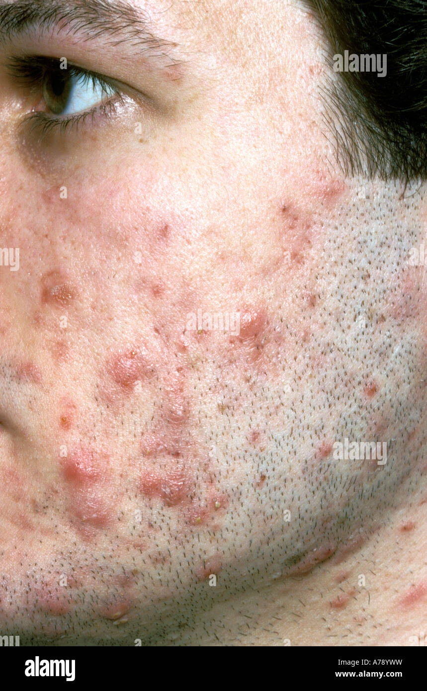 Cysts acne Banque de photographies et d’images à haute résolution - Alamy