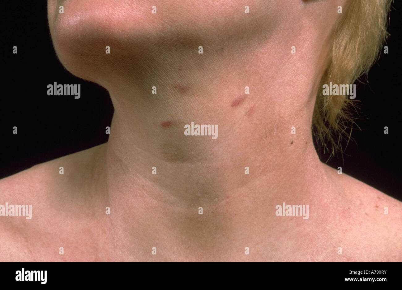 Sarcome de kaposi Banque de photographies et d’images à haute ...