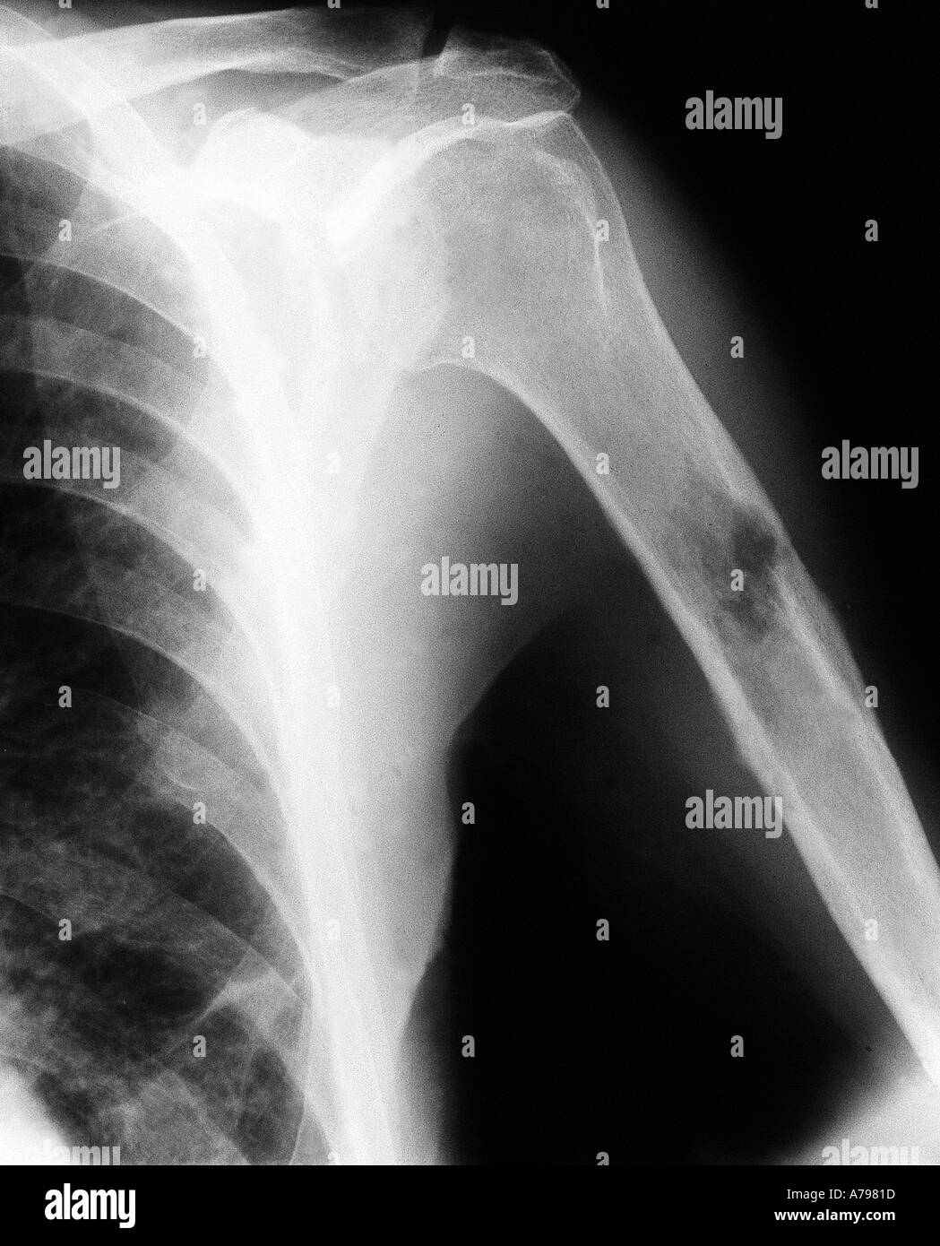 Cancer des os secondaire Banque de photographies et d’images à haute résolution - Alamy