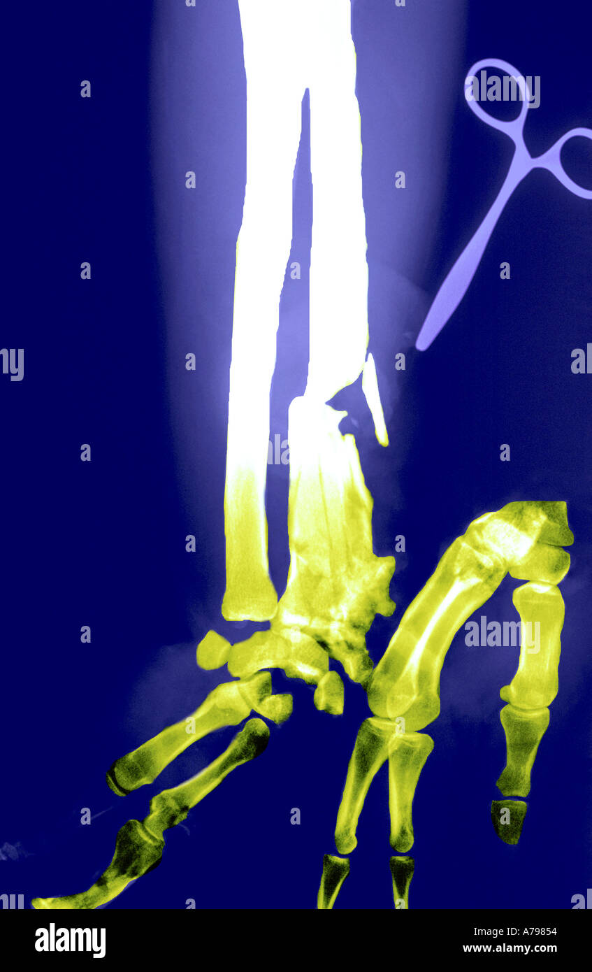 Fractured radius Banque de photographies et d’images à haute résolution ...