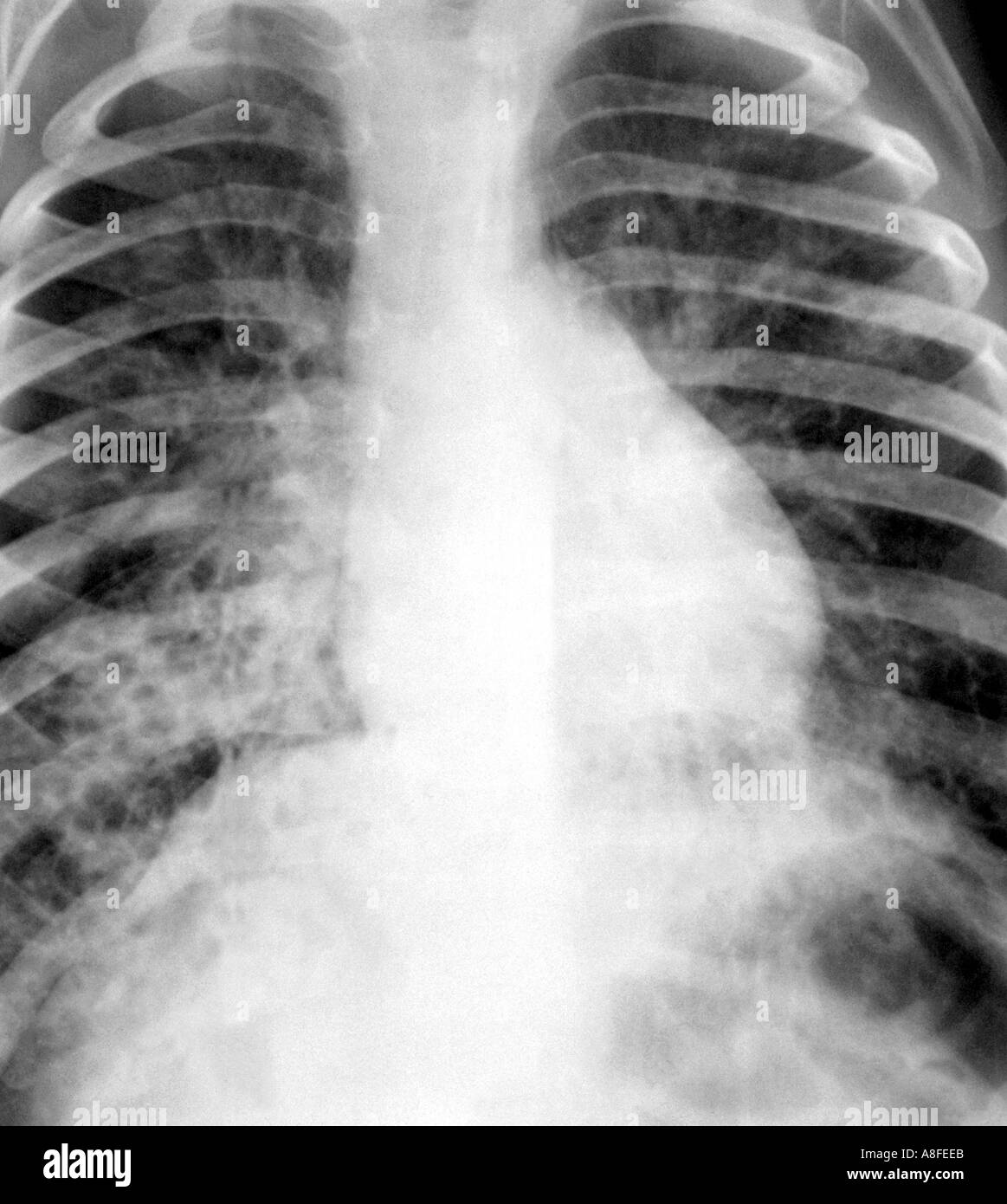 Radiographie pulmonaire fibrose Banque de photographies et d’images à ...