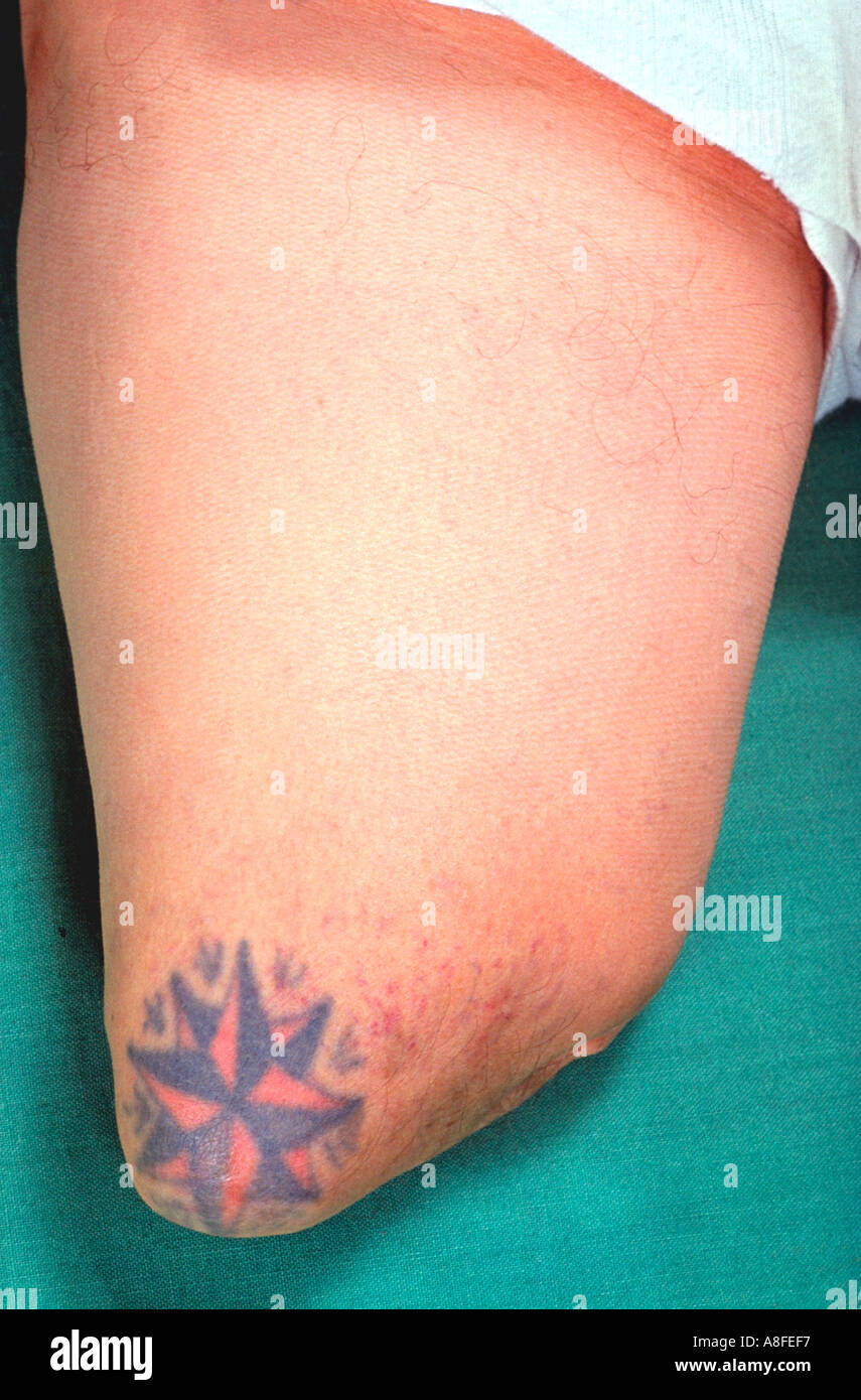 Amputee Amputation Banque d'image et photos - Page 2 - Alamy