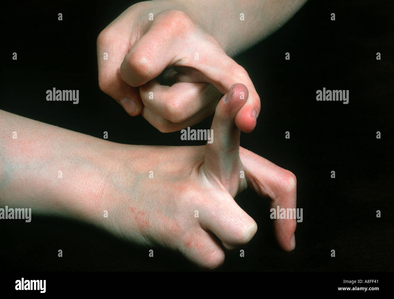Sindrome di ehlers danlos Banque de photographies et d’images à haute ...