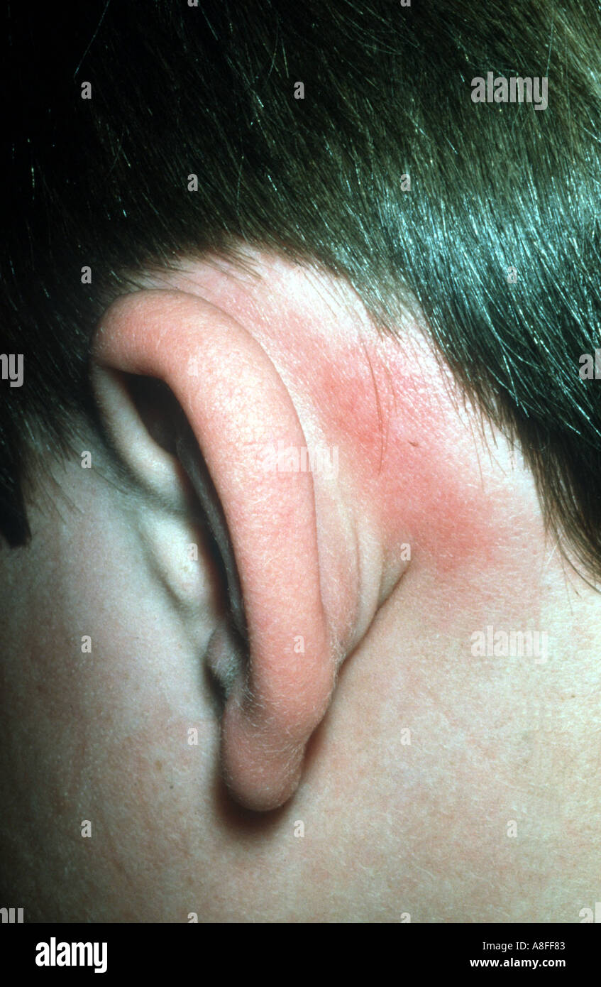 Acute mastoiditis Banque de photographies et d’images à haute ...